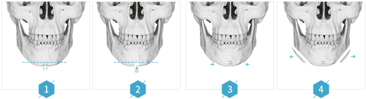 V-line Surgery in Korea - How to Get V-Line Face - ソウルガイドメディカル
