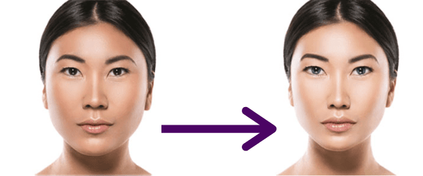 V-line Surgery in Korea - How to Get V-Line Face - ソウルガイドメディカル