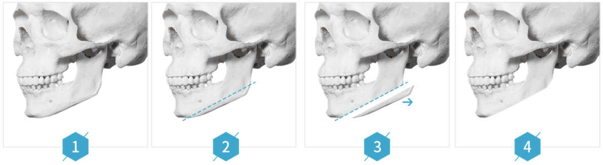 Square Jaw Reduction Surgery - ソウルガイドメディカル