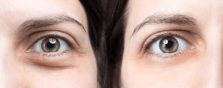Under Eye Correction Surgery - What You Need to Know for More Youthful ...