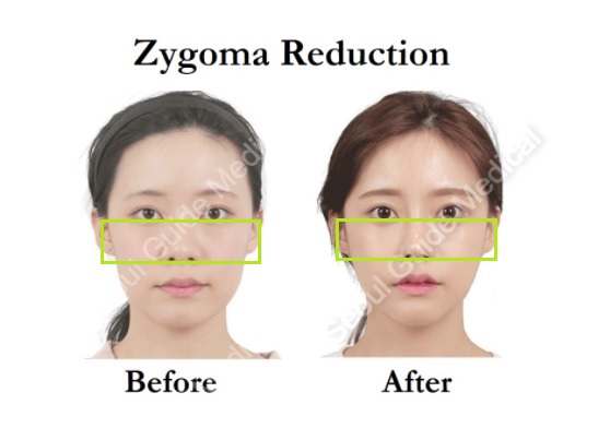 Your Guide to Getting Zygoma Reduction in Korea - ソウルガイドメディカル