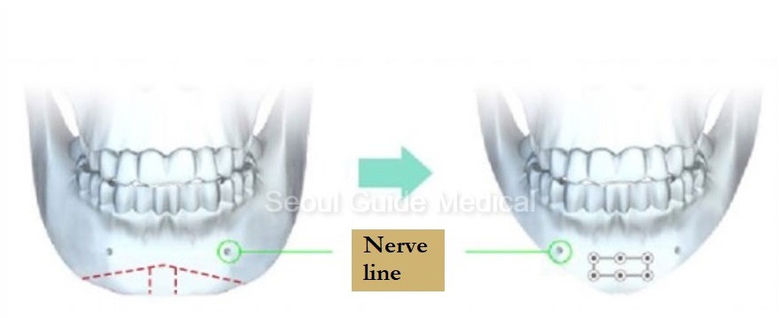 Genioplasty: Your Guide To Chin Surgery In South Korea - ソウルガイドメディカル