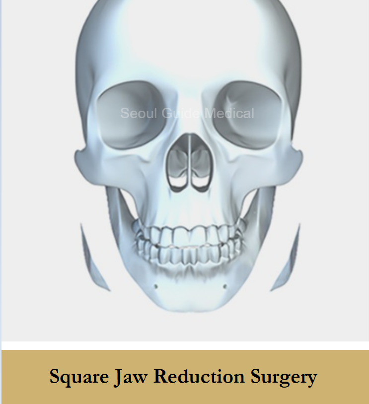 Square Jaw Reduction: Procedure Steps, Recovery Time, Costs, and Much ...