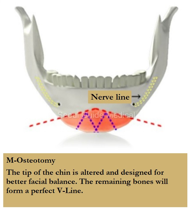 Genioplasty: Your Guide To Chin Surgery In South Korea - ソウルガイドメディカル