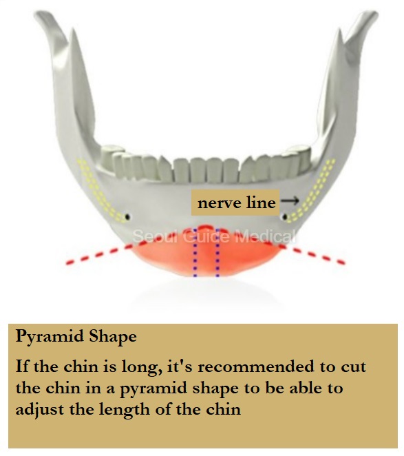 Genioplasty: Your Guide To Chin Surgery In South Korea - ソウルガイドメディカル