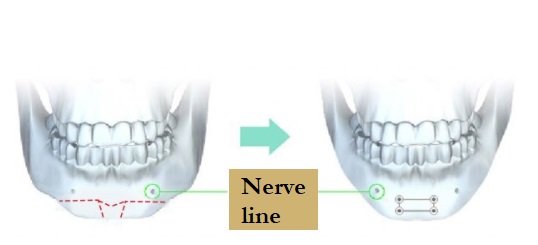 Genioplasty: Your Guide To Chin Surgery In South Korea - ソウルガイドメディカル
